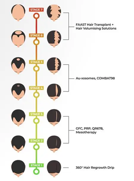What is Male Pattern Hair Loss? | The Éterne Clinic